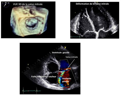 Insuffisance Mitrale Action Groupe