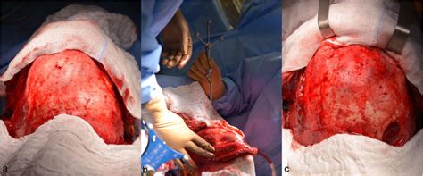 Intra Operative Pictures Of The Bone Resection In Patient Number 1