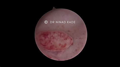 Hysteroscopic Polypectomy Youtube