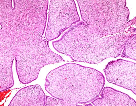 Adenosarcoma Of Uterus Light Micrograph Stock Image C057 7176 Science Photo Library