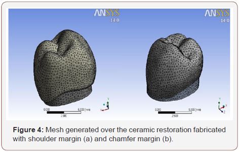 Influence Of Shoulder And Chamfer Margin Design On The Stress Distribution Pattern In Different