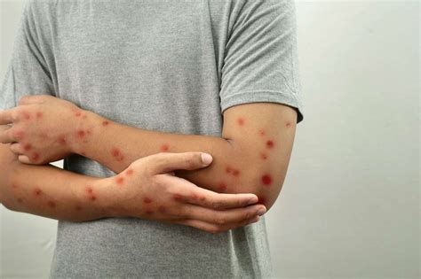 Intervalo Da Notícias Mpox O Que é A Doença E Como é Transmitida
