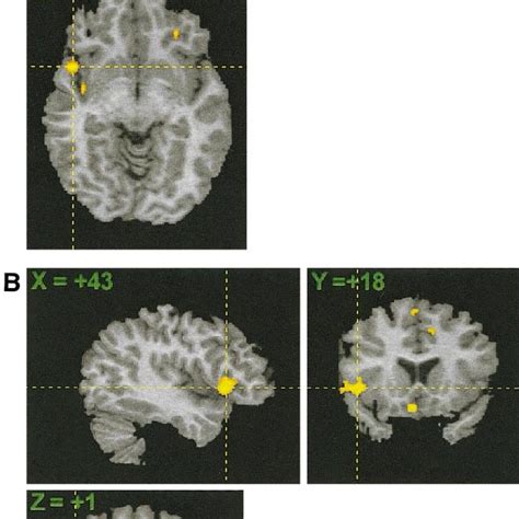 Slices Through The Insula Operculum In Sagittal Transverse And
