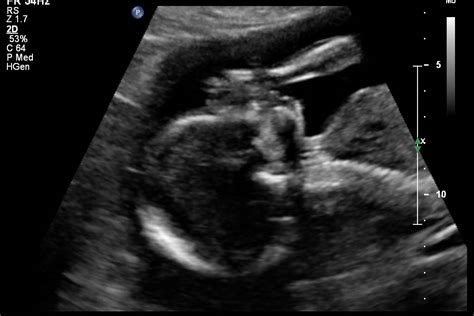 Who Shot Down My Stork 21 Weeks Anatomy Scan Results