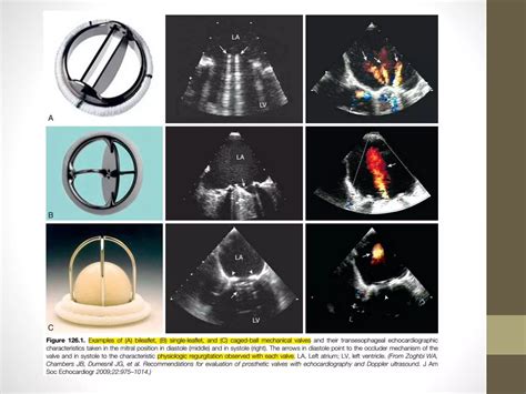 Assessment Of Prosthetic Valve Function Pptx