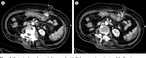 Pdf Endoscopic Closure Of A Gastric Perforation Developing As A