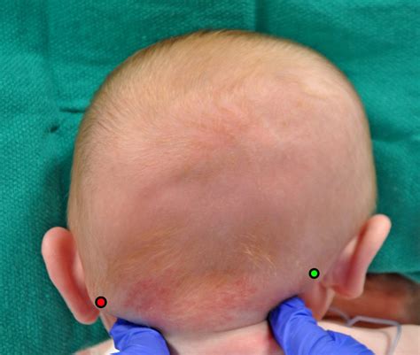Lambdoid Synostosis Facts And Photos Craniosynostosis