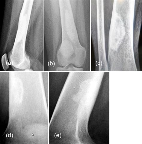Ossifying Fibroma Femur Management Of Paediatric Benign Bone Tumour
