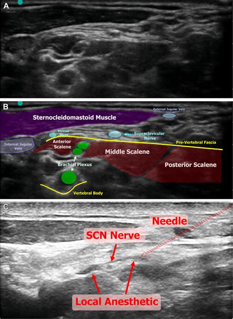 Ultrasound Guided Pecs 1 Block Download Scientific Diagram