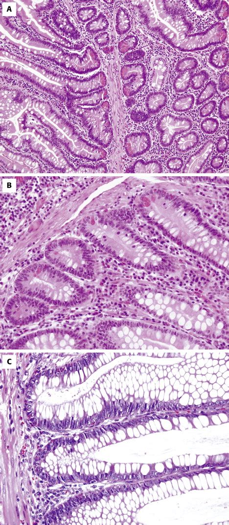 Gastrointestinal Polyposis Syndromes Abdominal Key