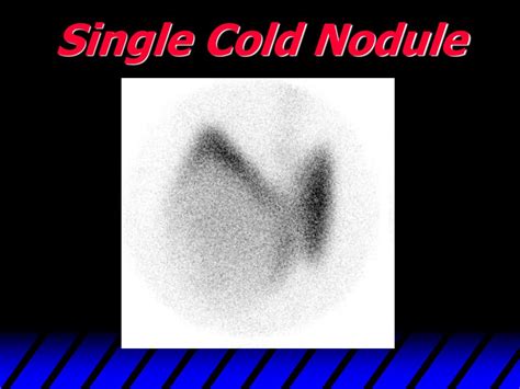 Ppt Thyroid Scan Powerpoint Presentation Free Download Id 437897