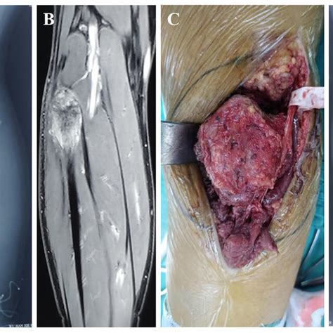 A Chondrosarcoma Of The Proximal Left Fibula Treated With Malawer Ⅱ Download Scientific Diagram