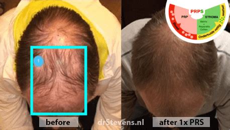 What Is PRPS PRPSclinics