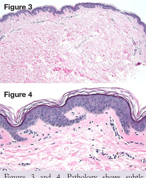 Figure 1 From A Case Of Progressive Macular Hypopigmentation Semantic