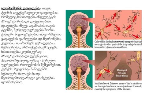 ალცჰაიმერის დაავადების გამომწვევი მიზეზები