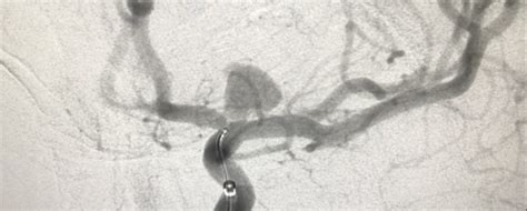 Cerus Endovascular Announces Implant Of Contour Device With Xcath Robot