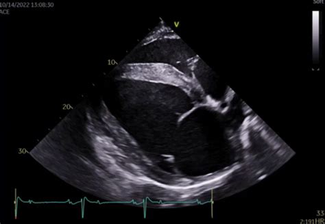 Echocardiogram Anatomy Flashcards Quizlet