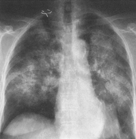 Pulmonary Edema And Symmetrical Bilateral Infiltrates Radiology Key