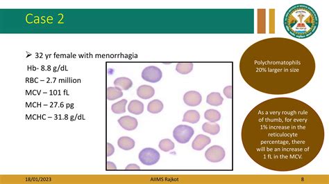 Macrocytic Anemia Pptx
