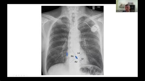 Ep1 The Cardiac Conduction System In Health And Disease Cvef Cardiac Device Ep Lecture