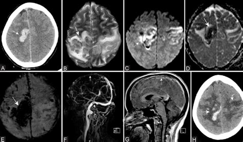 A H Non Contrast Ct Brain Axial Images Shows Hyperdense Area Arrow Download Scientific