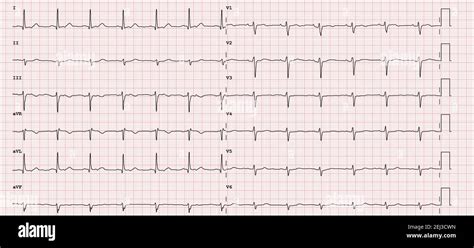 Sinus Rhythm 12 Lead Hot Sex Picture