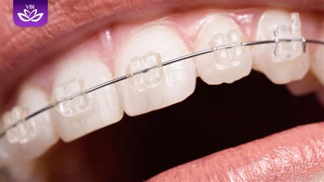 Ceramic Bracket Braces