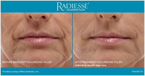 Dermal Fillers And Facial Fillers Radiance Medspa Wheaton