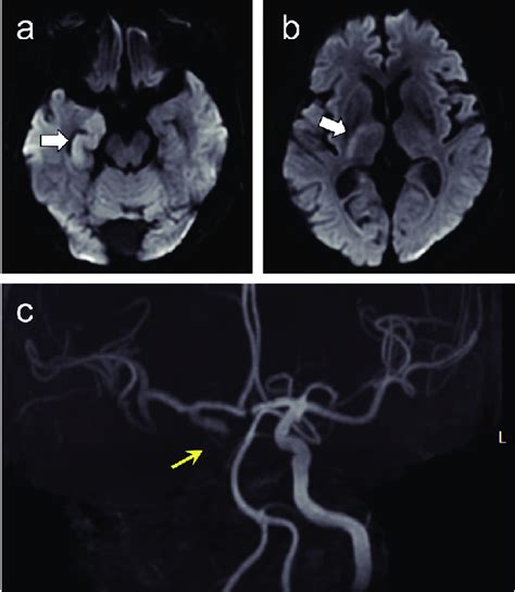 Multiple Mild Hyperintense Areas At The Right Medial Temporal Lobe A