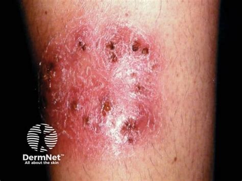 Fungal Skin Infection Images