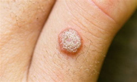 Types Of Warts And How To Treat Them A Visual Guide Allure 41 Off