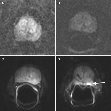 Prostate Mri Using An External Phased Array Wearable Pelvic Coil At 3t