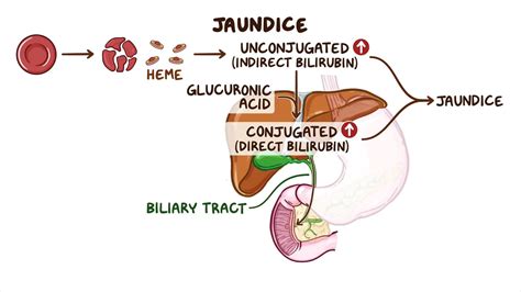 Approach To Jaundice Unconjugated Hyperbilirubinemia Clinical Sciences Osmosis Video Library