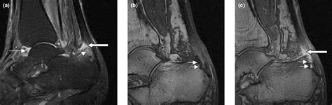 Arthritis Psoriatic Psoriasis Arthritic Psoriasis Arthropathica