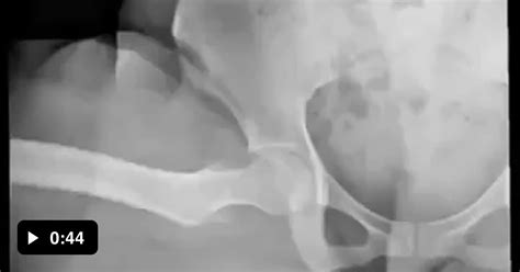 Dynamic Digital Radiography Low Dose X Ray Imaging Technique Enables Visualization Of Anatomy In