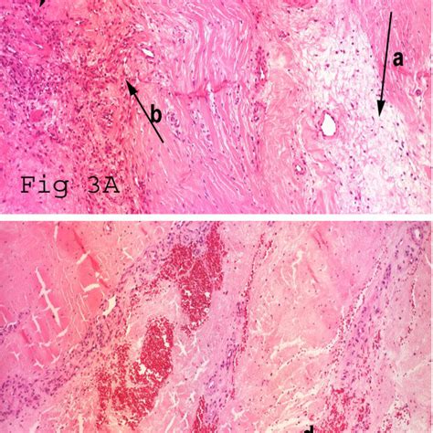 Clinical Picture Showing Positive Sulcus Sign In The Suprapatellar