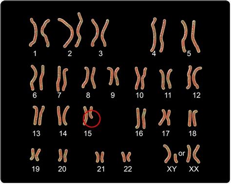 What Is Prader Willi Syndrome