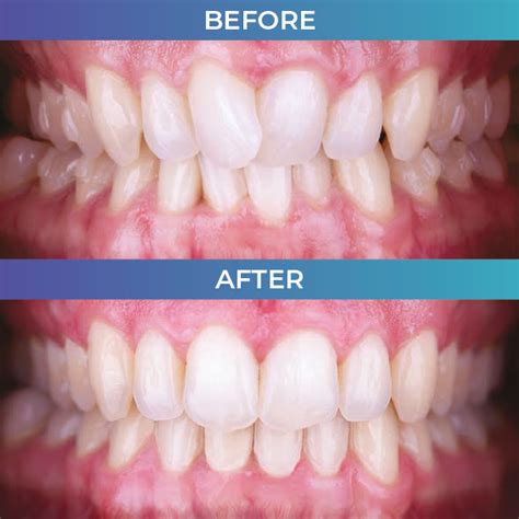 Crowding On Upper And Lower Teethmidline Discrepancy Trioclear®