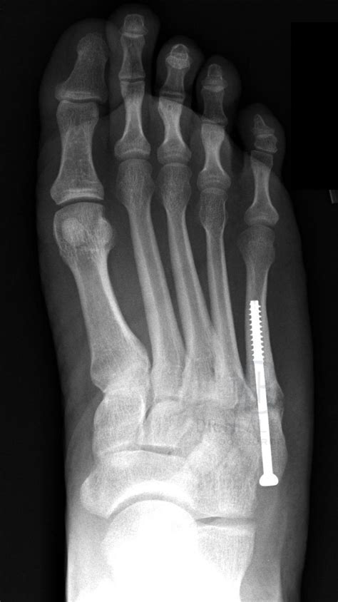 4 Types Of Fifth Metatarsal Fracture Metatarsal Fracture Jones Fracture Foot Surgery Recovery