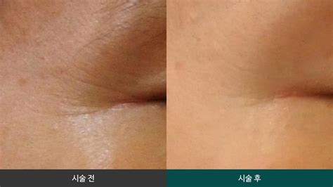 듀엣rf 디아트의원 청주피부과