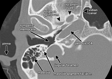 Mastoid Foramen Ct