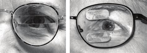 A Press On 40 Δ Fresnel Peripheral Prism Segments In The Oblique