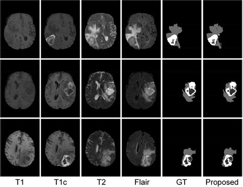 Three Cases Of Qualitative Segmentation Results On Brats Dataset Using