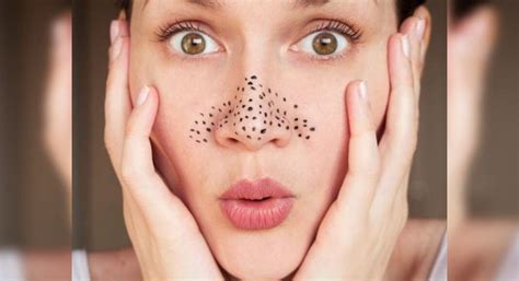 Dos And Don Ts For Blackhead Removal