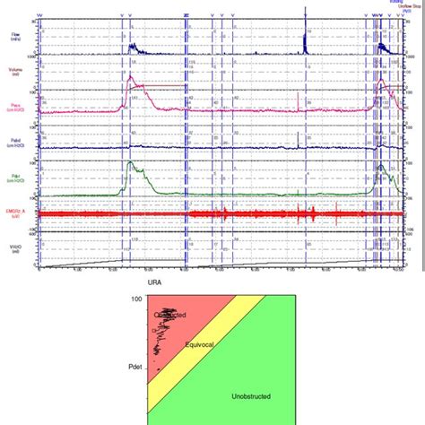 Cystometrogram Cmg And Pressure Flow Study With Bladder Outlet