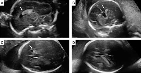 Choroid Plexus Ultrasound