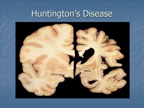 Ppt What Is The Basal Ganglia A Journey Into The Deep Nuclei