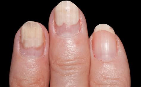 Nail Signs Onycholysis 甲松离 Tangs Clinical Tcm