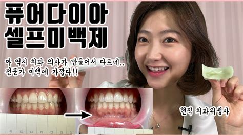 현직 치과위생사가 추천하는 셀프미백제 퓨어다이아 2주 사용 후기 Youtube