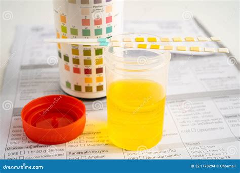 Urinalysis Urine Cup With Reagent Strip Ph Paper Test And Comparison Chart In Laboratory Stock